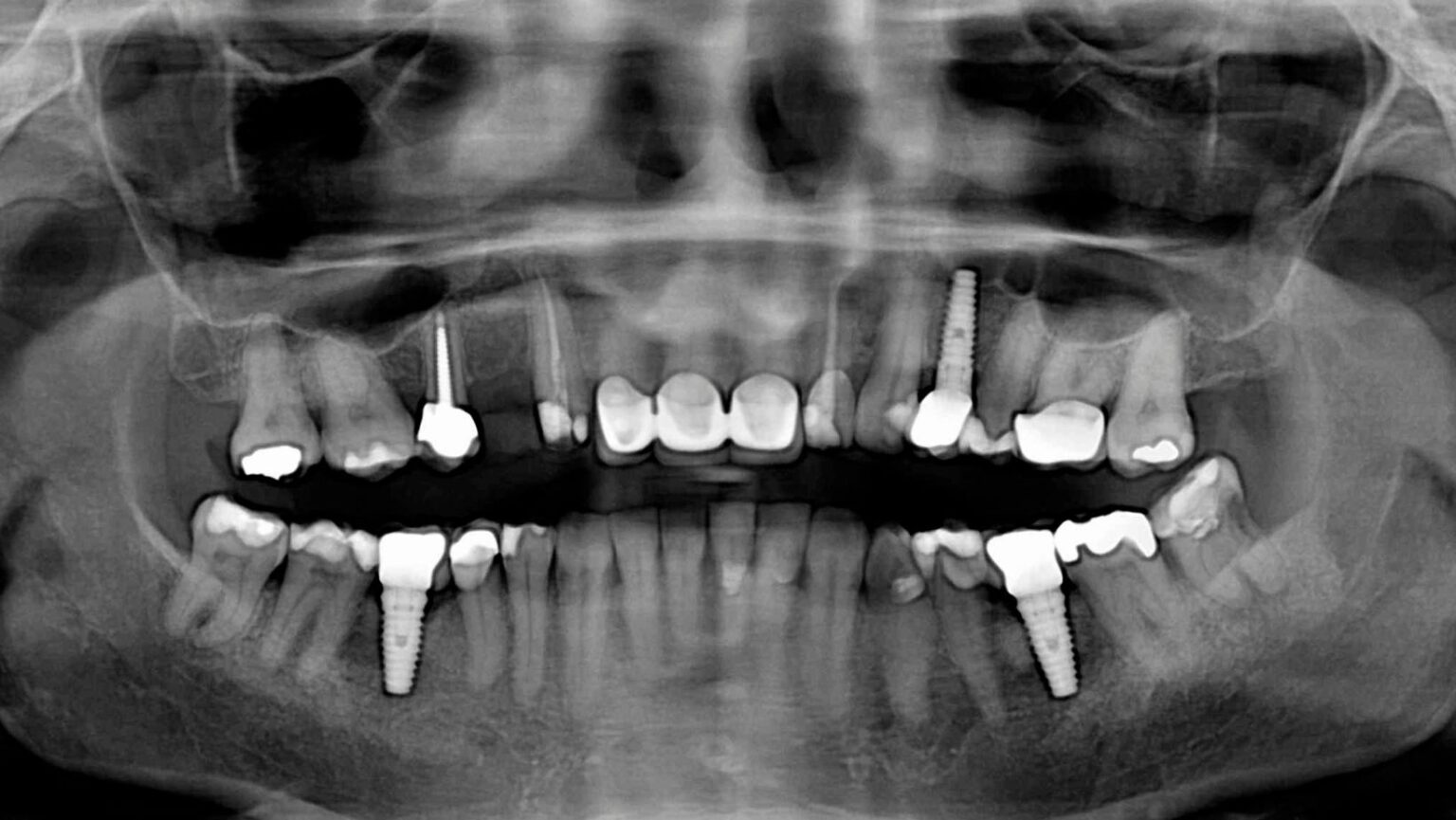 All-on-4 vs All-on-X Implants: Understanding Full-Arch Options ...
