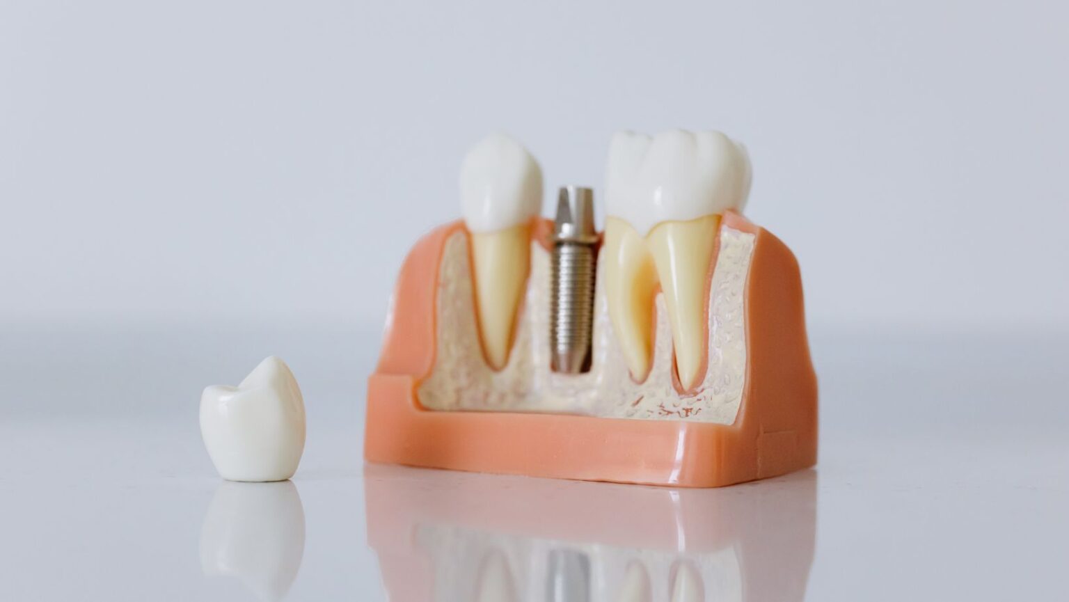 Dental Implants in Chula Vista: What Patients Should Know Before ...